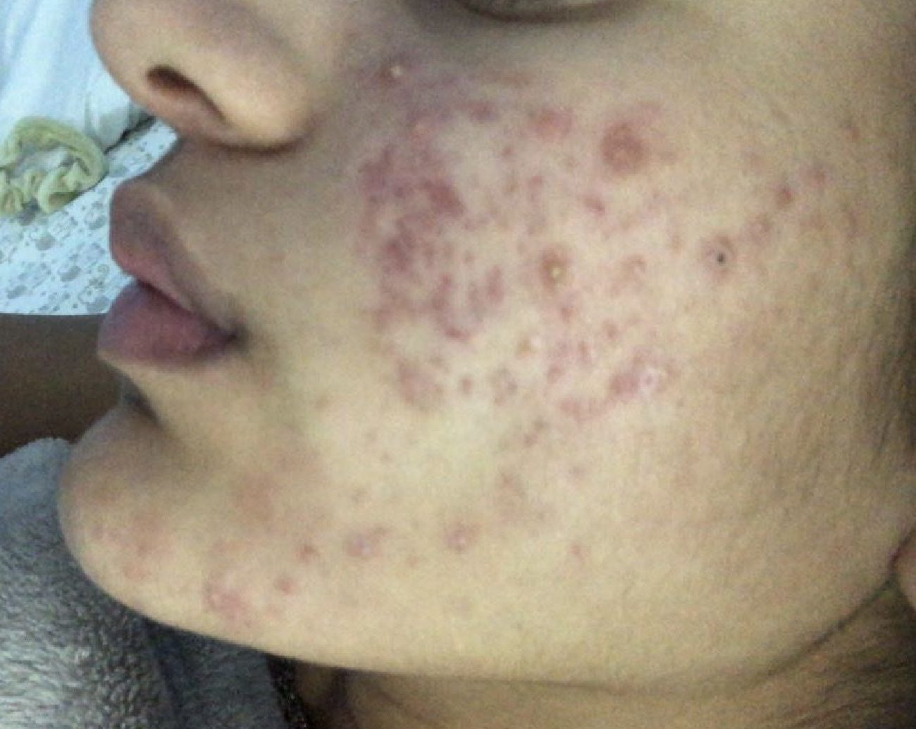 Acne Treatment NJ | Acne Treatment New Jersey | Anaramedspa